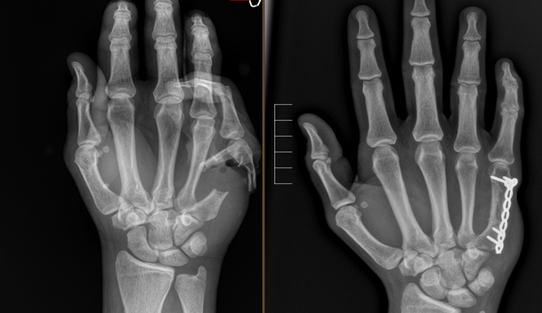 Hand Surgery Fellowship Information | Department of Orthopaedic Surgery ...
